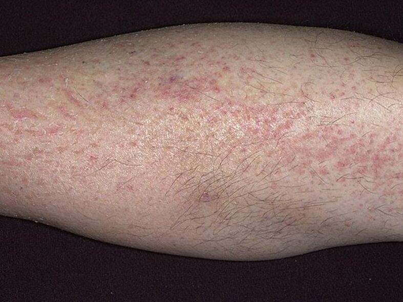 Psoriasis sur les jambes symptômes, stades, types, diagnostic et ...