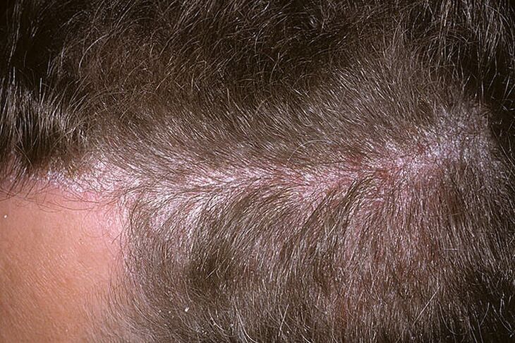 Psoriasis sur la tête: photo, comment traiter la maladie du cuir ...