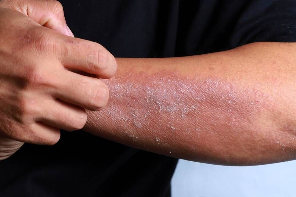 Psoriasis - causes et traitement de la maladie | Site officiel Dr. DERM