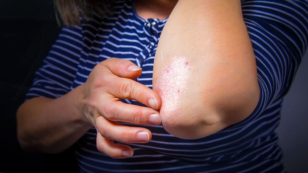 Psoriasis sur les coudes: méthodes de traitement, causes, symptômes ...