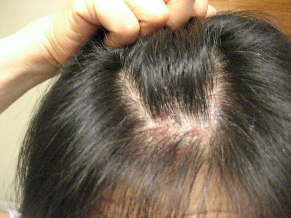 Quelles sont les causes du psoriasis: les principales causes et ...