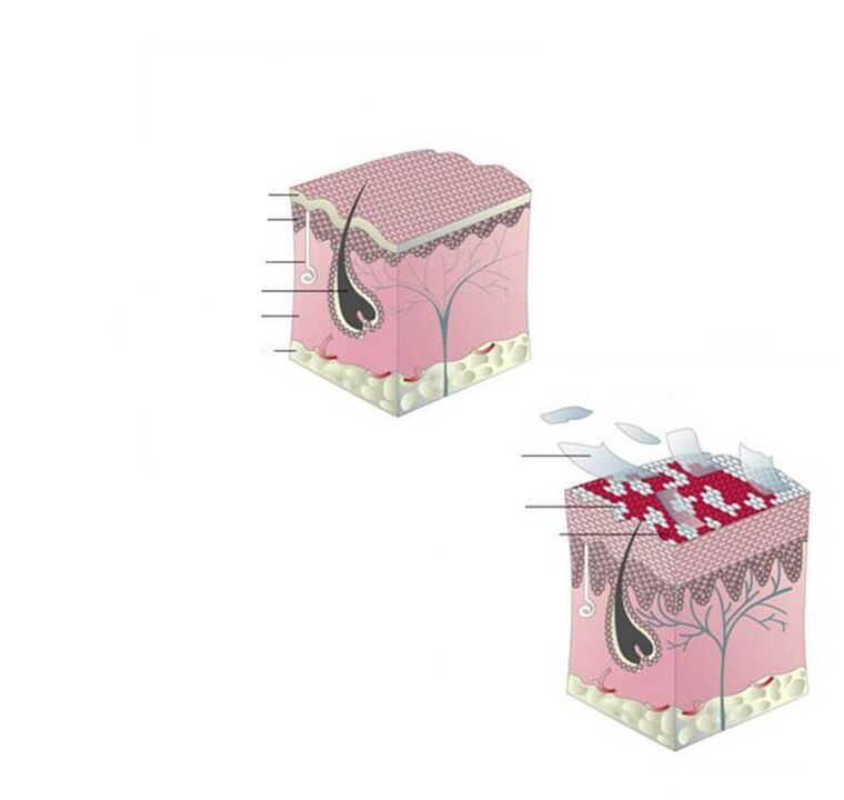 Psoriasis. Peau sèche et enflammée | Site officiel Dr. DERM