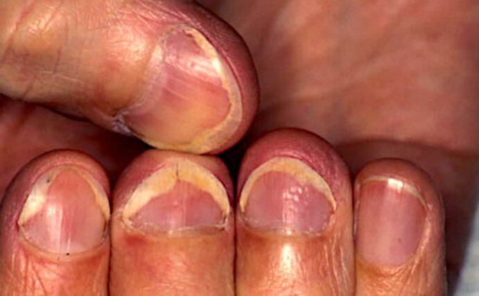 Psoriasis des ongles sur les mains et les pieds: causes, diagnostic et ...