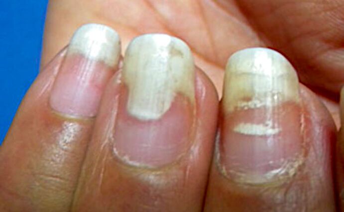 Psoriasis des ongles sur les mains et les pieds: causes, diagnostic et ...