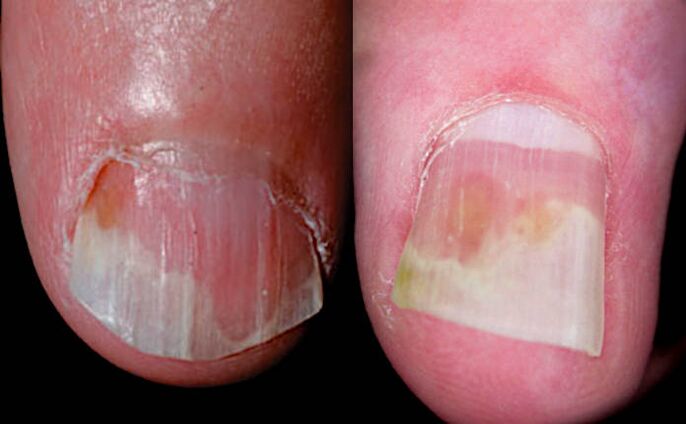 Psoriasis des ongles sur les mains et les pieds: causes, diagnostic et ...